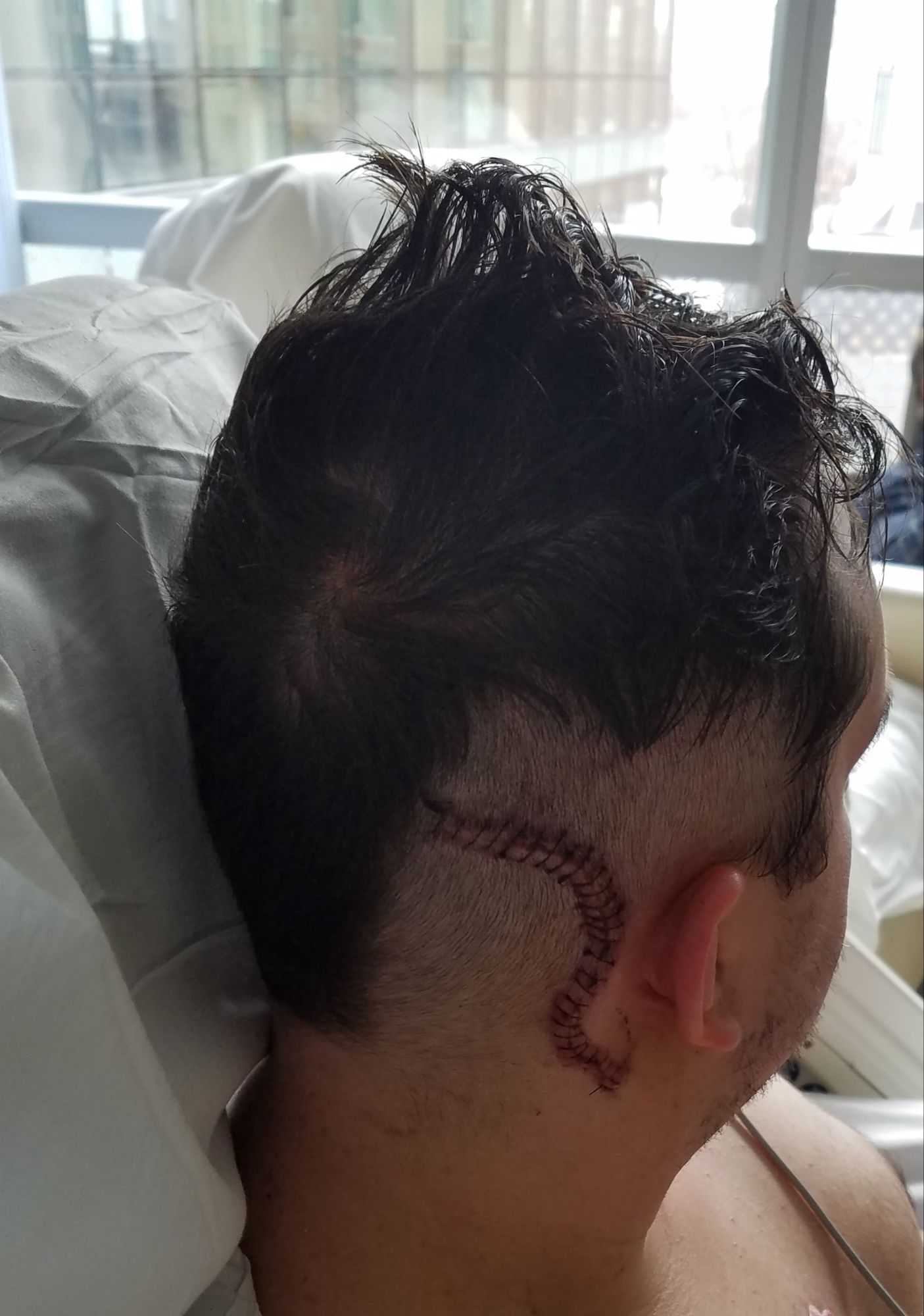 Brain Surgery and Hair – The "Lucky" Brain Tumor