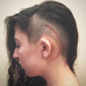 Brain Surgery and Hair – The "Lucky" Brain Tumor